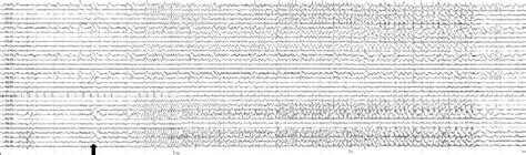 A Scalp EEG Findings Of Patient With Generalized Attenuation On Download Scientific Diagram