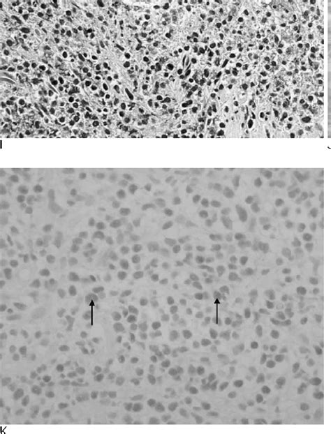 Figure 1 From Primitive Neuroectodermal Tumor Of Mediastinum In An Adult A Case Report