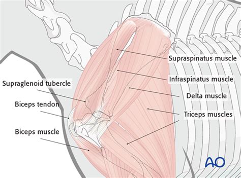 Supraglenoid Tubercle Fractures