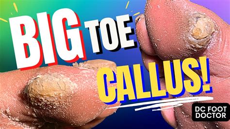 Big Toe Callus Youtube