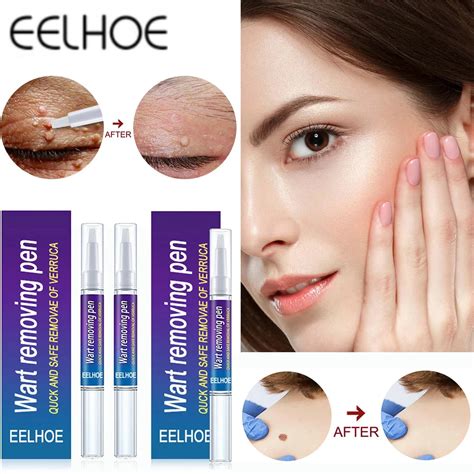 사마귀 제거 두더지 액체 펜 치료 유두종 제거 피부 태그 제거 납작한 생식기 사마귀 무통 크림 안티 베루카 치료 크림 Aliexpress