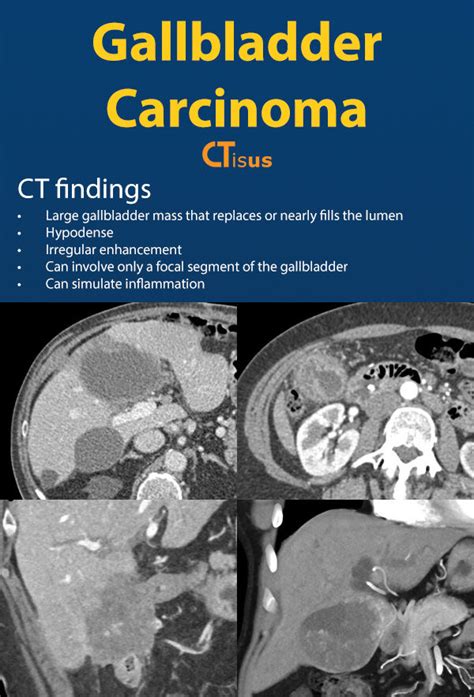 Gallbladder Carcinoma Gvzu2spz Ctisus
