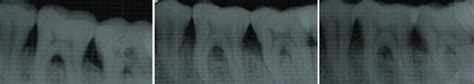 Intraoral Periapical Radiograph With Grid Showing Infrabony Defect In Download Scientific