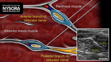 Tips For An Obturator Nerve Block Distal Approach Nysora Tips For An Obturator Nerve Block Distal Approach Nysora