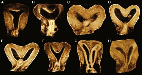 Two And Three Dimensional Ultrasonography And Sonohysterography Versus Hysteroscopy With