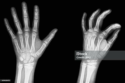 손의 엑스레이 지골과 관절의 세부 사항 공중 그네 주상골 피라미드 Pisiform Capitate 원위 정면 근위부 Interflaginian Lunate