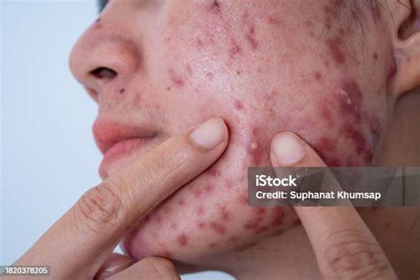 얼굴에 여드름이 나기 때문에 피지선의 질환이 생깁니다 여드름 또는 미용 알레르기 호르몬 변화와 음식은 피부 알레르기 증상을 유발합니다 여드름에 대한 스톡 사진 및 기타