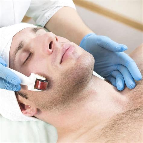 Does Derma Roller Help With Acne Scars Lolysenta