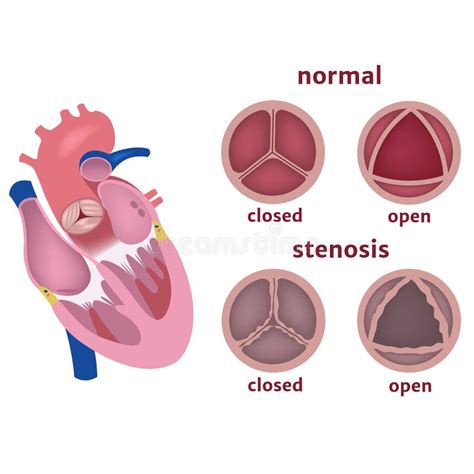 Aortic Insufficiency Stock Illustrations 13 Aortic Insufficiency