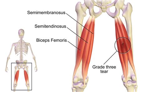 Pulledhamstring Massage Therapy London