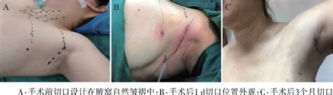 Table 1 From Endoscopic Thyroidectomy Using Gasless Axillary Approach For Low Risk Papillary