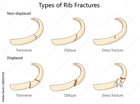 Juliste Types Of Rib Fractures Non Displaced And Displaced Fractures Transverse Oblique