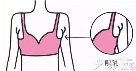 双侧副乳切除手术是不是去除腋毛和狐臭的好方法 我来解答 整容资讯 彩贝整容网