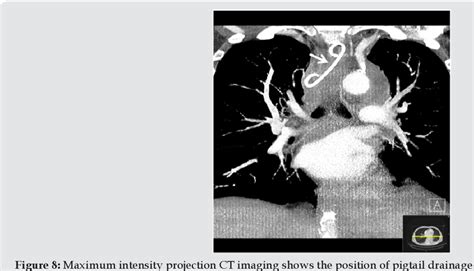 Figure 1 From Necrotizing Pancreatitis With Mediastinal Abscess Formation Semantic Scholar