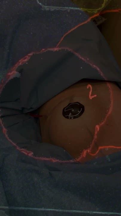 Подтяжка груди без имплантов Youtube