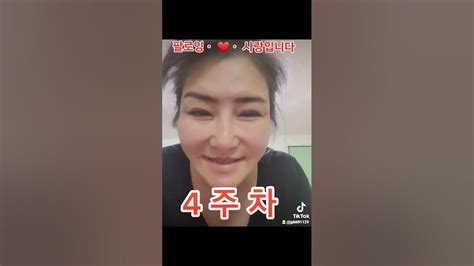 얼굴 리프팅 주름제거 4주차 테이핑ㆍ 아직까진 프부 트러블 없구요 일주일뒤 경과보고 하겠습니다 성형않하고 미간ㆍ팔자주름 ㆍ