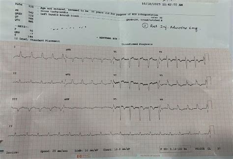 SVT WITH LEFT BUNDLE BRANCH BLOCK FOLLOWING GASTRECTOMY Kauvery Hospital