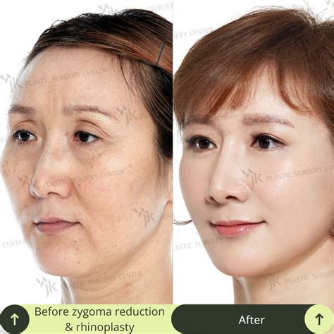 Cheek Bone Zygomatic Reduction South Korea From Aud 75 Week Glamjet