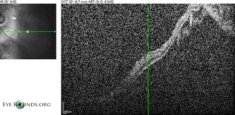 Rhegmatogenous Retinal Detachment Oct