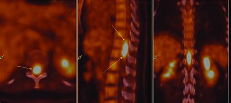Atypical Spinal Cord Lymphoma Infiltration Transversal And Sagittal