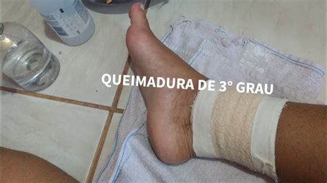 Cicatriz De Queimadura De 3 Grau Nazaedu