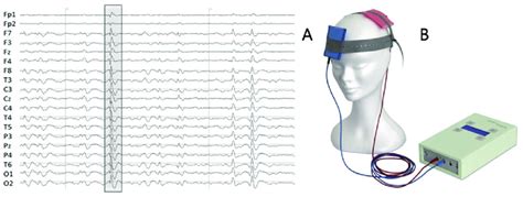 A An Example Of 2 S Patients Eeg With Typical Interictal Download Scientific Diagram