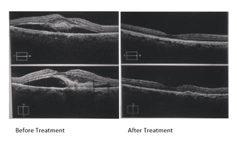 Hope For Patients With Macular Degeneration And Diabetic Macular Edema