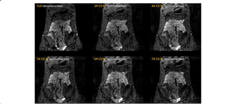 Compressed Sensing And Parallel Imaging Cs Pi Reconstructions From Download Scientific