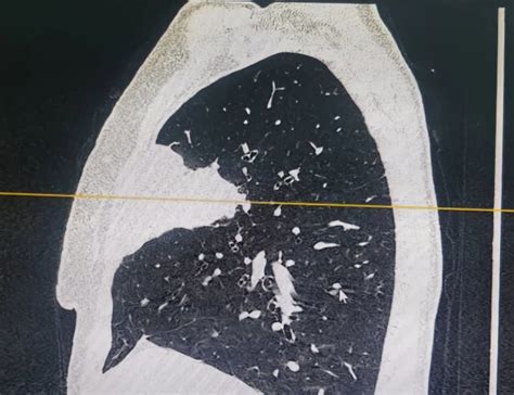 Mohammed Ibrahim Abdalla Ahmed On Linkedin Case 21 Bulging Fissure Sign Rt Middle Lobe