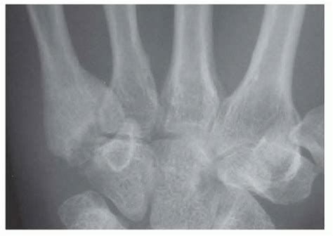 Operative Treatment Of Finger Carpometacarpal Joint Fracture Dislocations Musculoskeletal Key