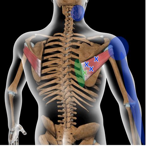 Supraspinatus Trigger Point