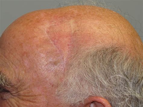 Scalp Reconstruction 4 Skin Cancer And Reconstructive Surgery Center