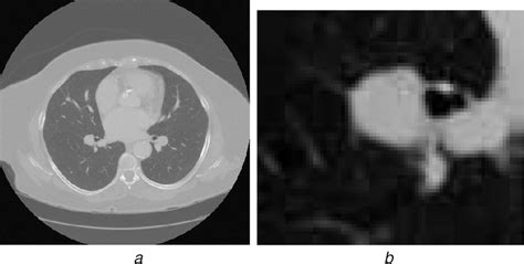 Denoising Results By Rpca A Denoising Image B Partially Enlarged Image Download
