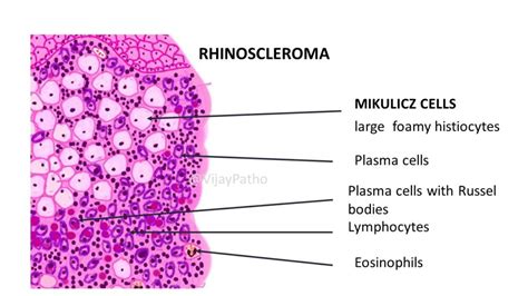 Rhinoscleroma Pathology Made Simple
