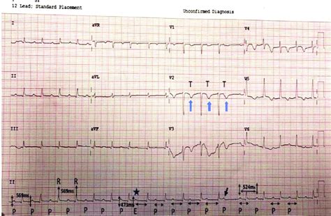Prolonged Pr Interval