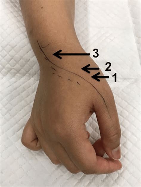 Triggering Seen Most Obviously At The Base Of The First Metacarpal Bone Download Scientific