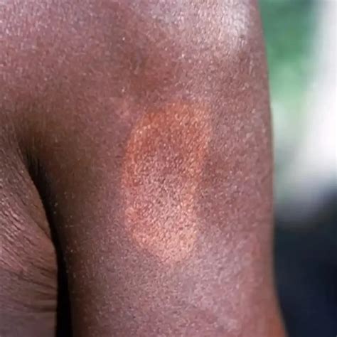 8 Common Skin Diseases Types Best Causes Symptoms