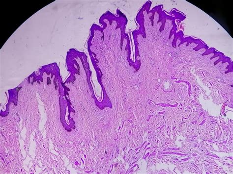 40 Calcinosis Pictures