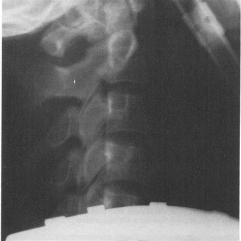 Pdf Unilateral Cervical Facet Subluxationdislocation