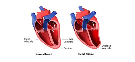 Types Of Heart Failure Diastolic Vs Systolic Dr Raghu
