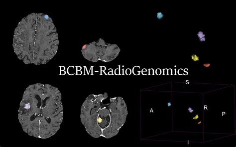 New Dataset Mri Dataset Of Metastatic Breast Cancer To The Brain With Expert Reviewed