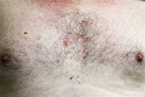 Folliculitis Of The Chest Stock Image C023 8917 Science Photo Library