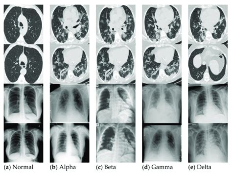 Sample CT Scan And X Ray Images Of The Database Of Different Variants Download Scientific