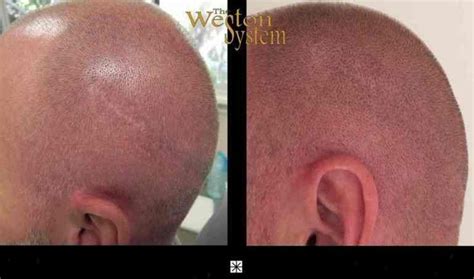 10 Hair Transplant Scar Camouflage Hair Restoration News Worldwide
