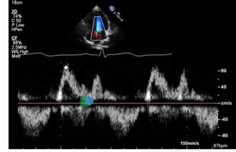 CCI ECHO Flashcards Quizlet