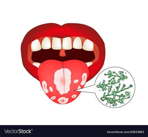 Oral Thrush Candidiasis On Tongue Fungus In Vector Image
