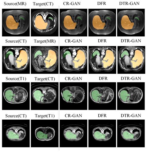 Dtr Gan An Unsupervised Bidirectional Translation Generative Adversarial Network For Mri Ct
