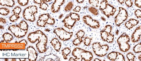 Biogenex On Linkedin Biogenex Prostatecancer Innovationinmedicine