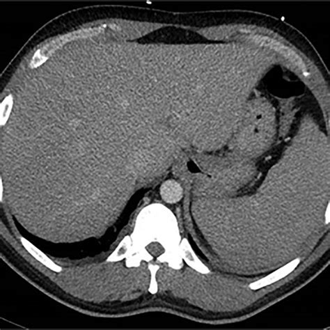 Computed Tomography Of The Abdomen Demonstrating Hepatomegaly With