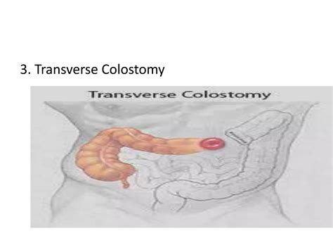 Colostomy PPTX Digestive Disorders Diseases And Conditions